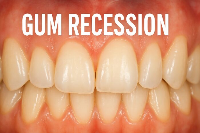 Gum Recession: Causes, Signs, How to Stop It and Treatment